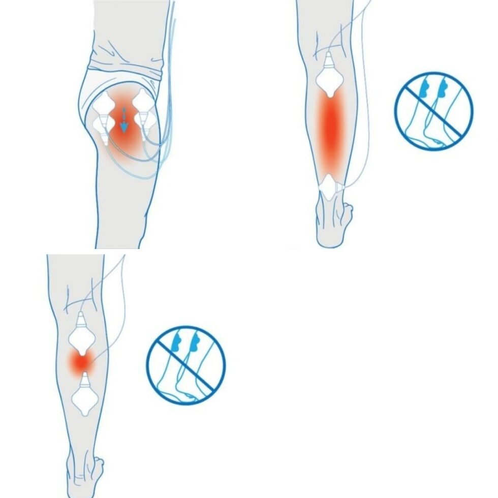 Where Do I Place My Electrodes? - TENS EMS UNIT